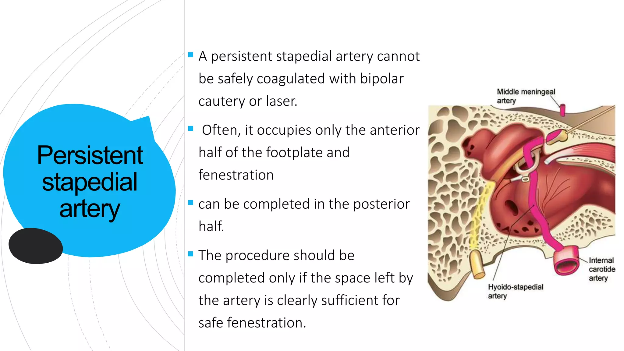 Complications of Stapes surgery.pptx | Ear, Nose and Throat Conditions ...