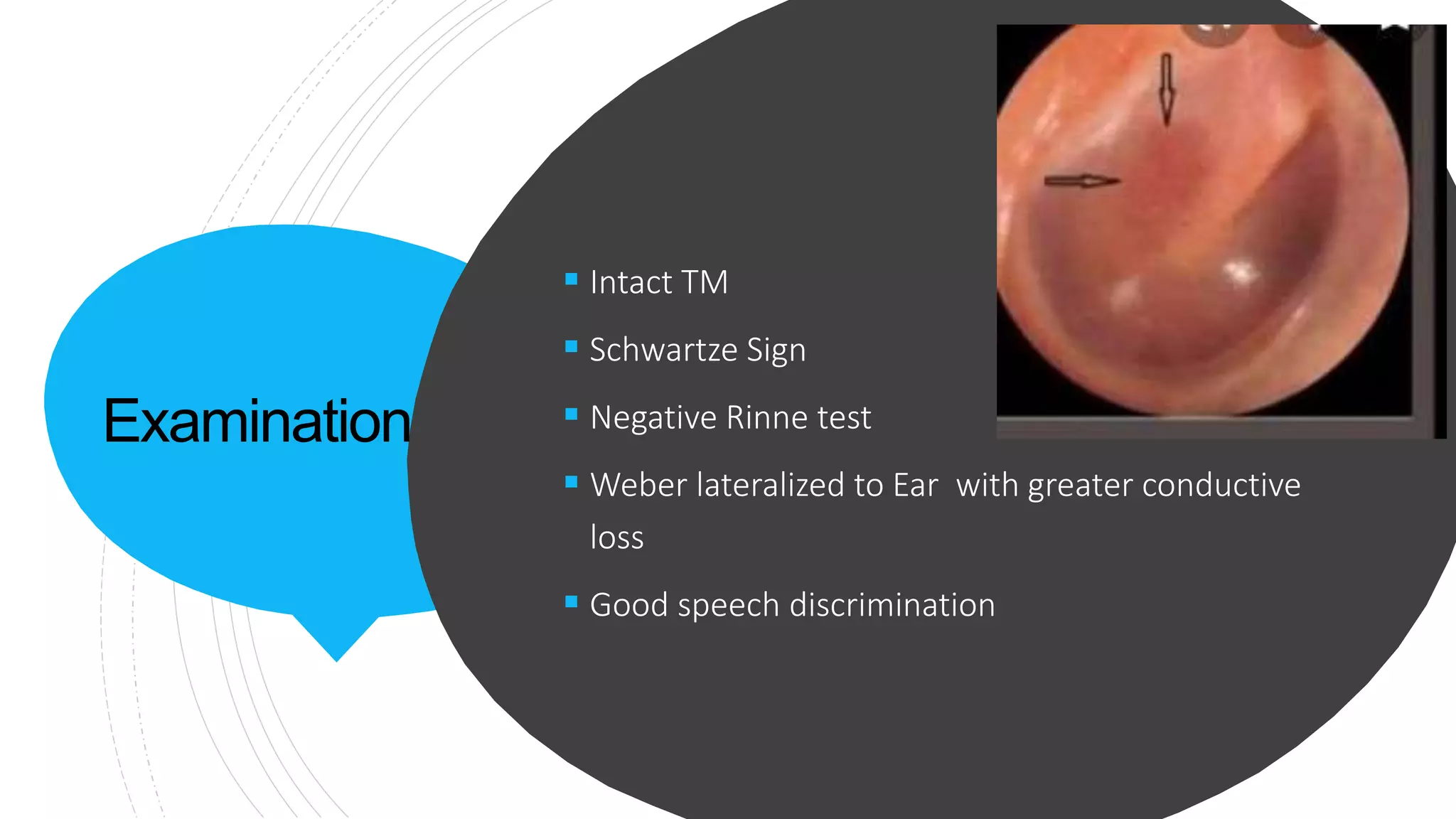 Complications of Stapes surgery.pptx
