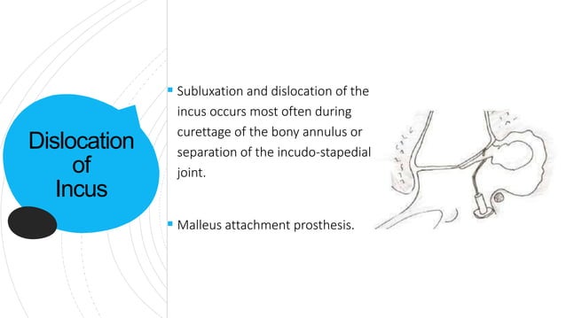 Complications of Stapes surgery.pptx | Ear, Nose and Throat Conditions ...