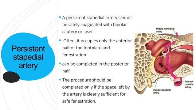 Complications of Stapes surgery.pptx | Ear, Nose and Throat Conditions ...