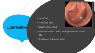 Complications of Stapes surgery.pptx