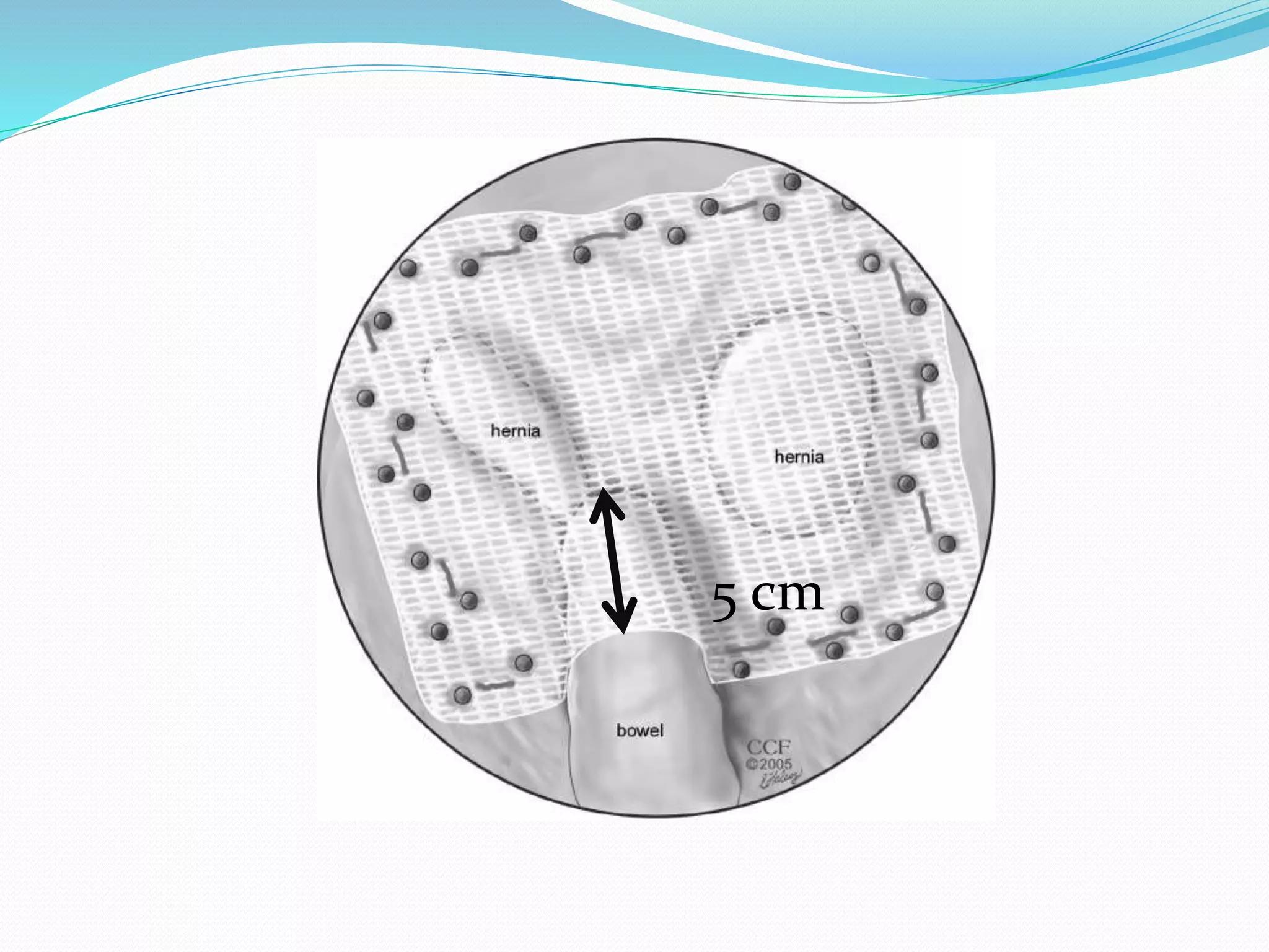 Complications of stomas | PPTX | Skin and Dermatology | Diseases and ...
