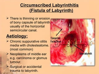 Complications of suppurative otitis media | PPT