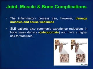 Complications of systemic lupus erythematosus | PPT