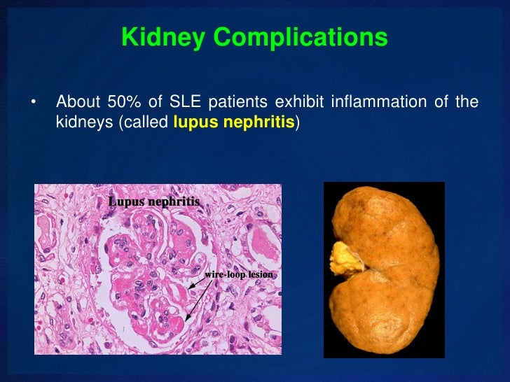 Lupus Causes Kidney Failure at Olivia Quinn blog