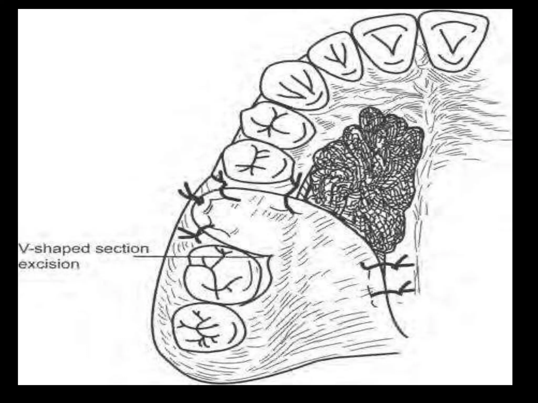 Complications of teeth extraction | PPSX