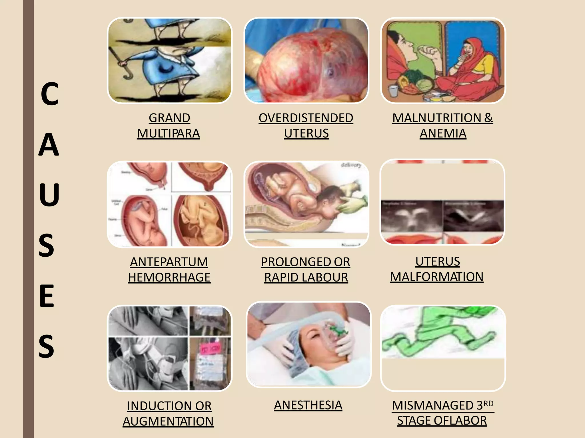 Complications of 3 rd stage of the Labour | PPTX