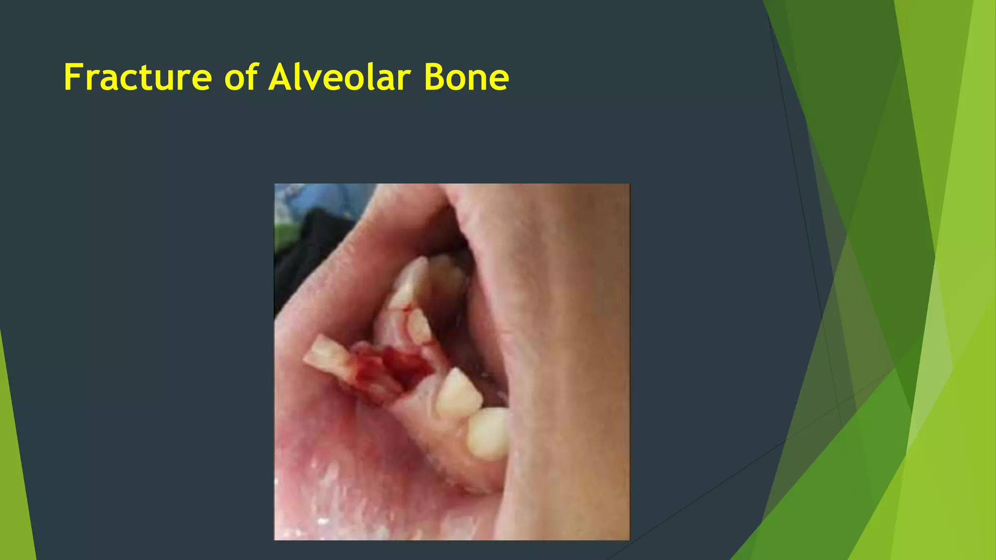 Complications of tooth extraction | PPT Complications of tooth extraction | PPT