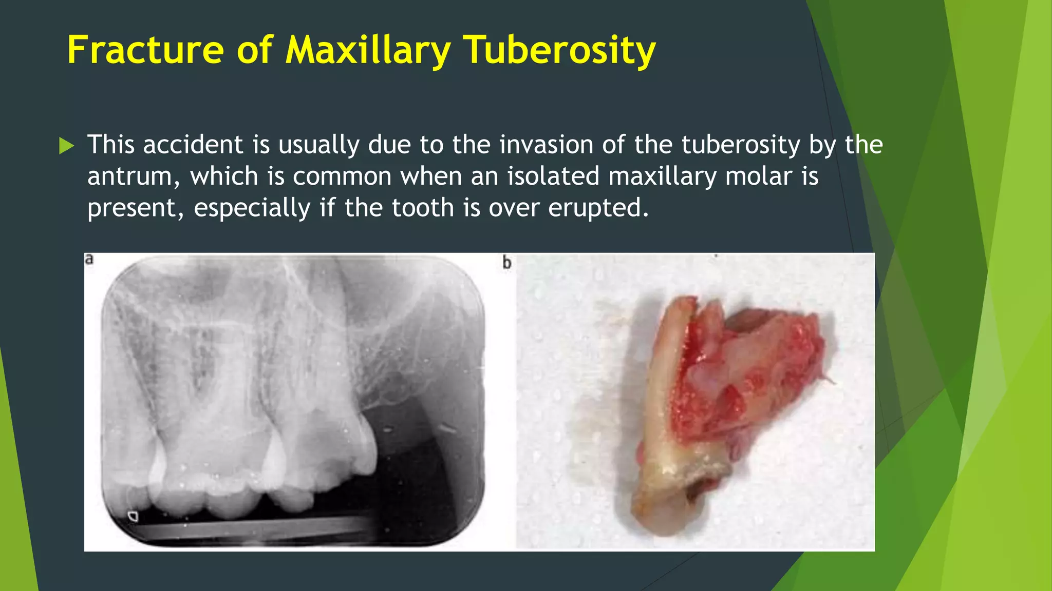 Complications of tooth extraction | PPTX