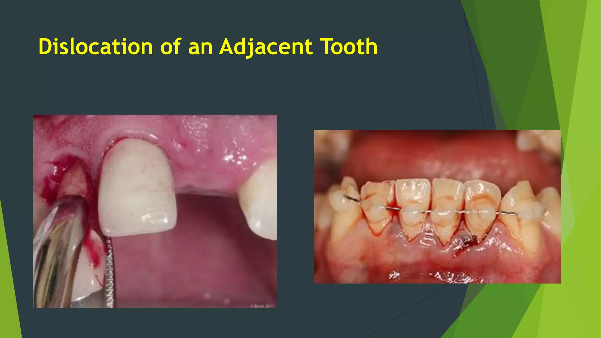 Complications of tooth extraction | PPT Complications of tooth extraction | PPT