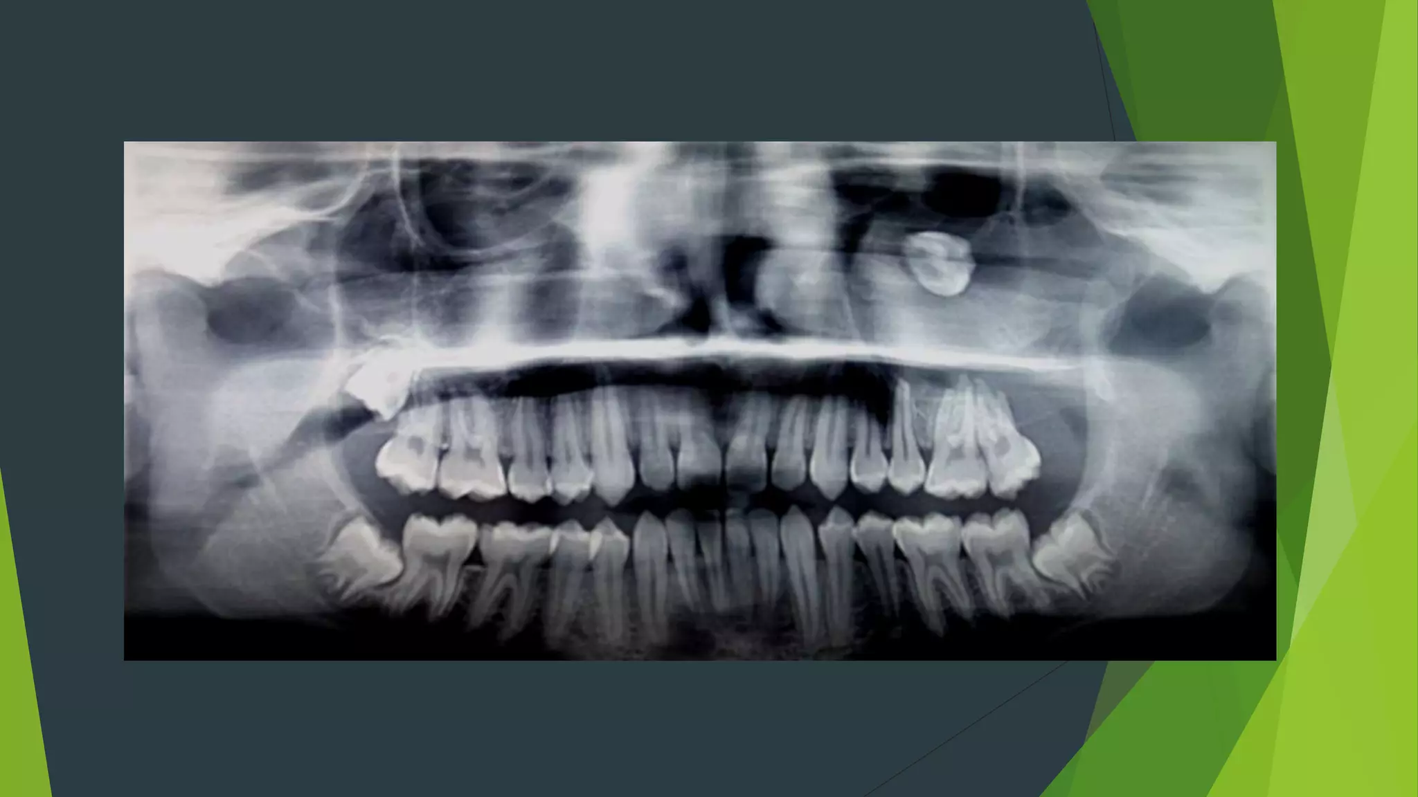 Complications of tooth extraction | PPTX