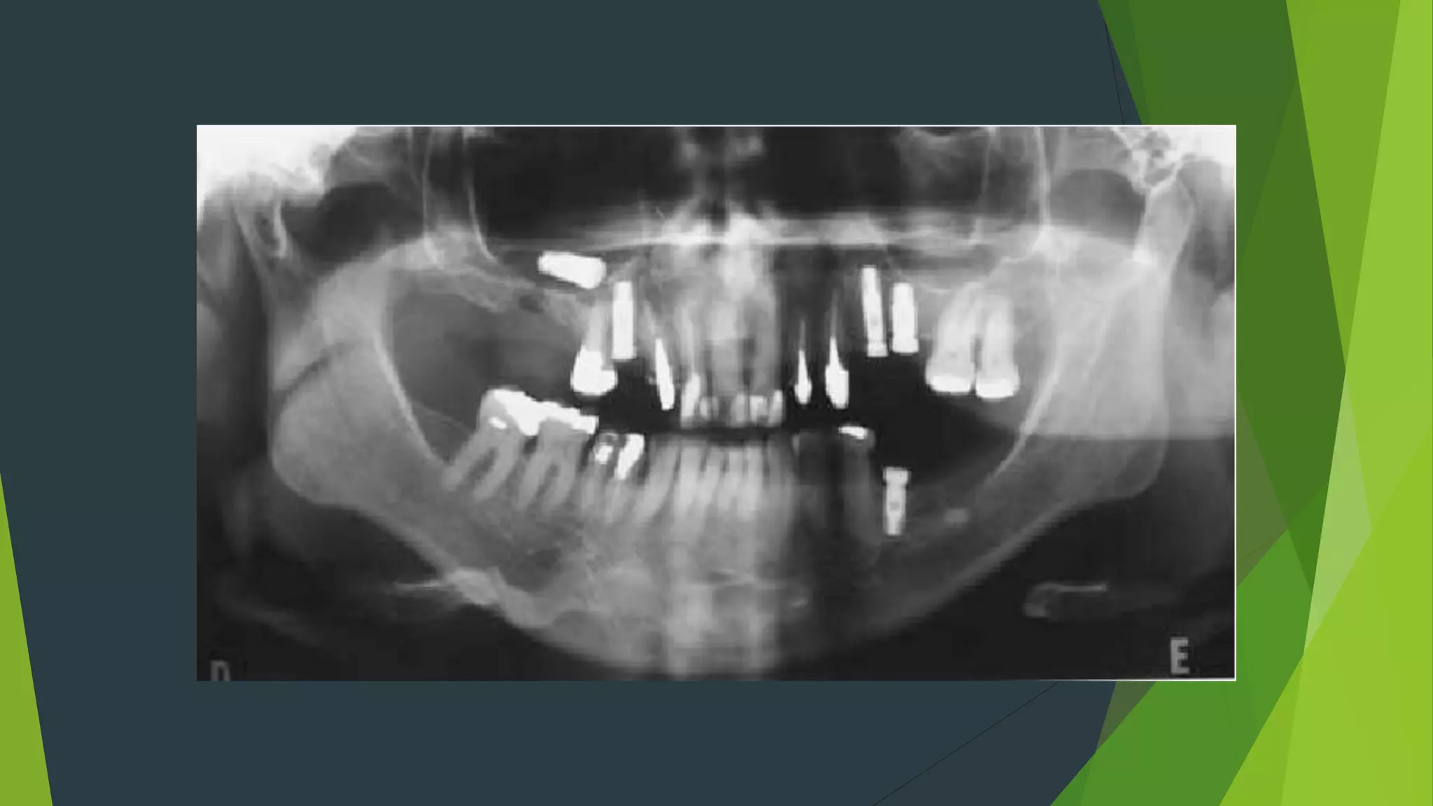 Complications of tooth extraction | PPTX