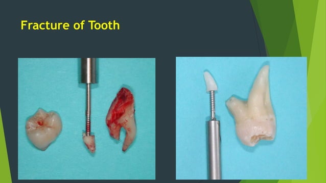 Complications of tooth extraction | PPTX