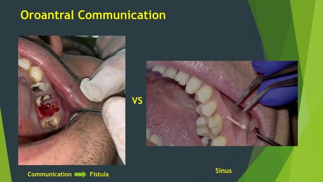 Complications of tooth extraction | PPTX