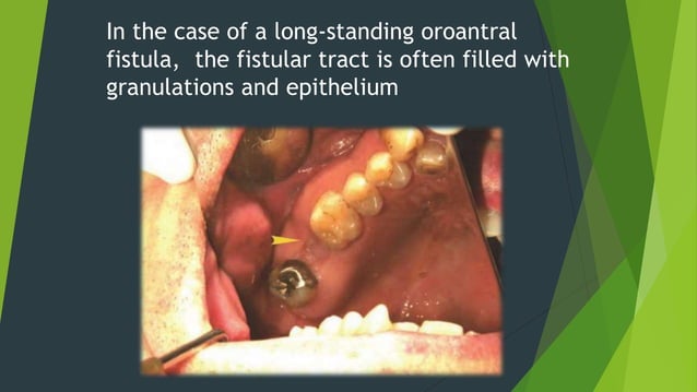 Complications of tooth extraction | PPTX