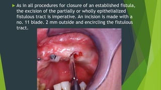 Complications of tooth extraction | PPTX