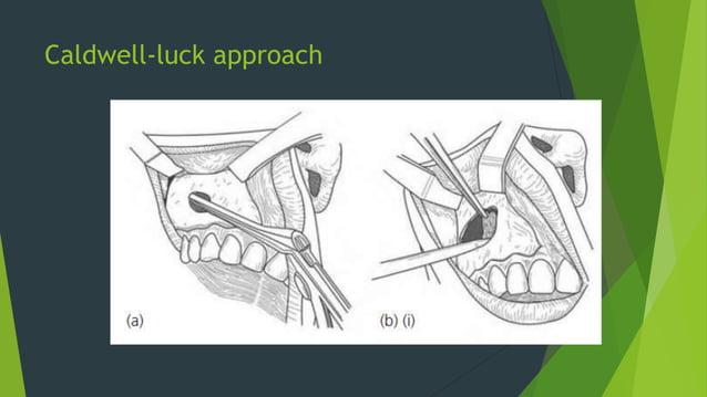 Complications of tooth extraction | PPTX