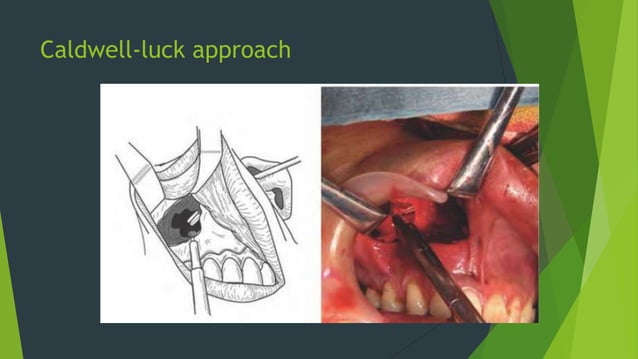 Complications of tooth extraction | PPTX