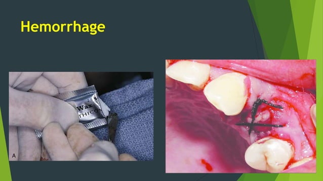 Complications of tooth extraction | PPTX