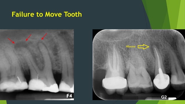 Complications of tooth extraction | PPTX