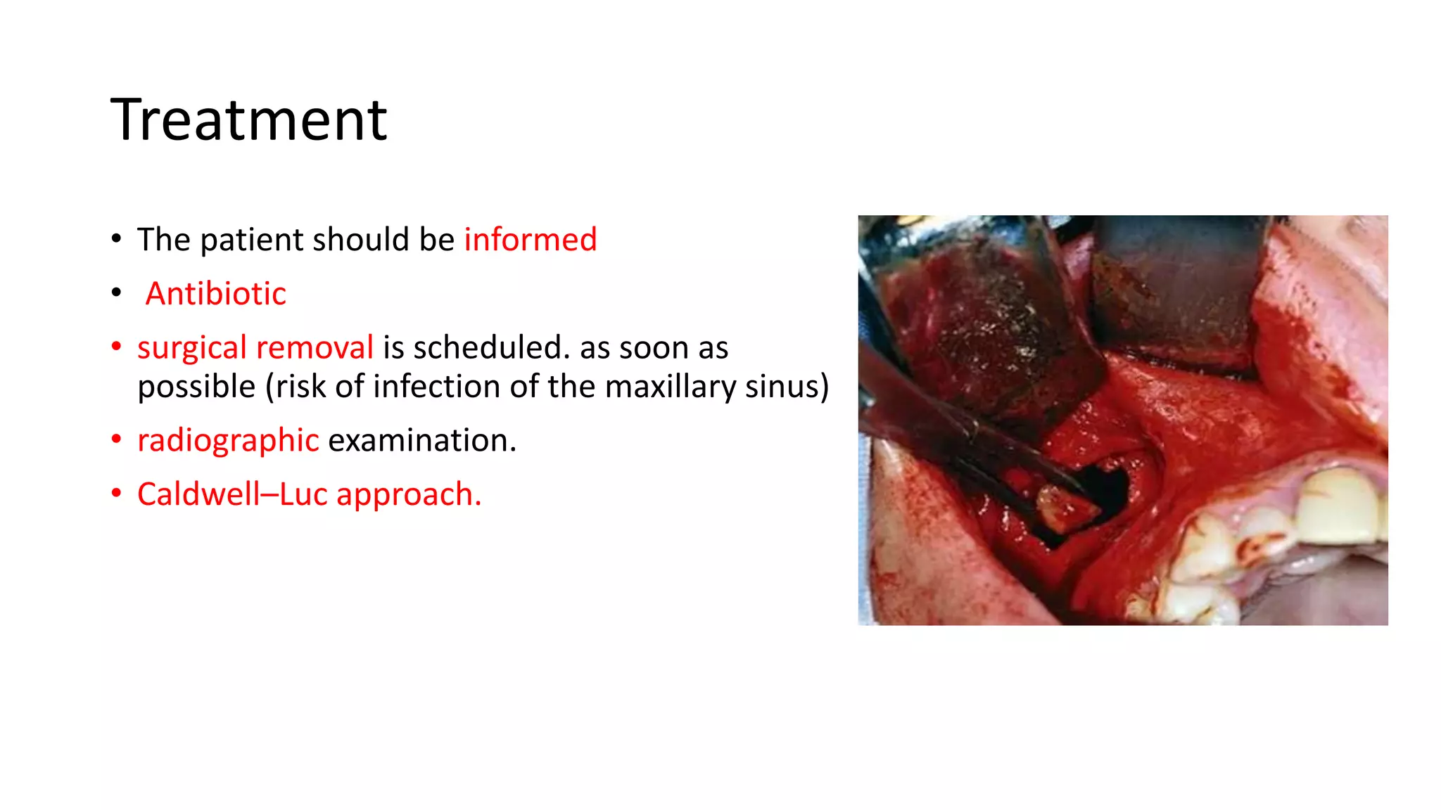 Complications of tooth extraction.pptx
