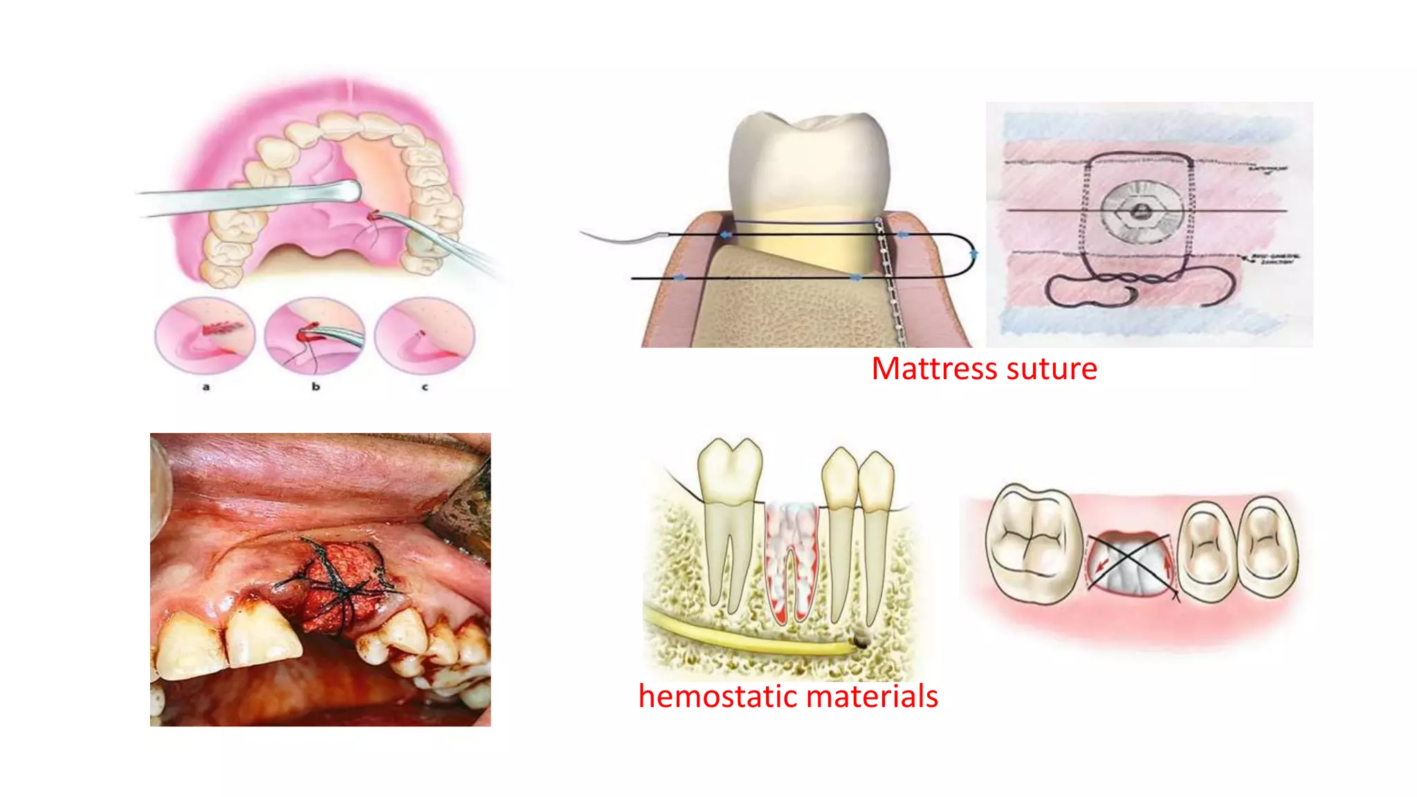 Complications of tooth extraction.pptx