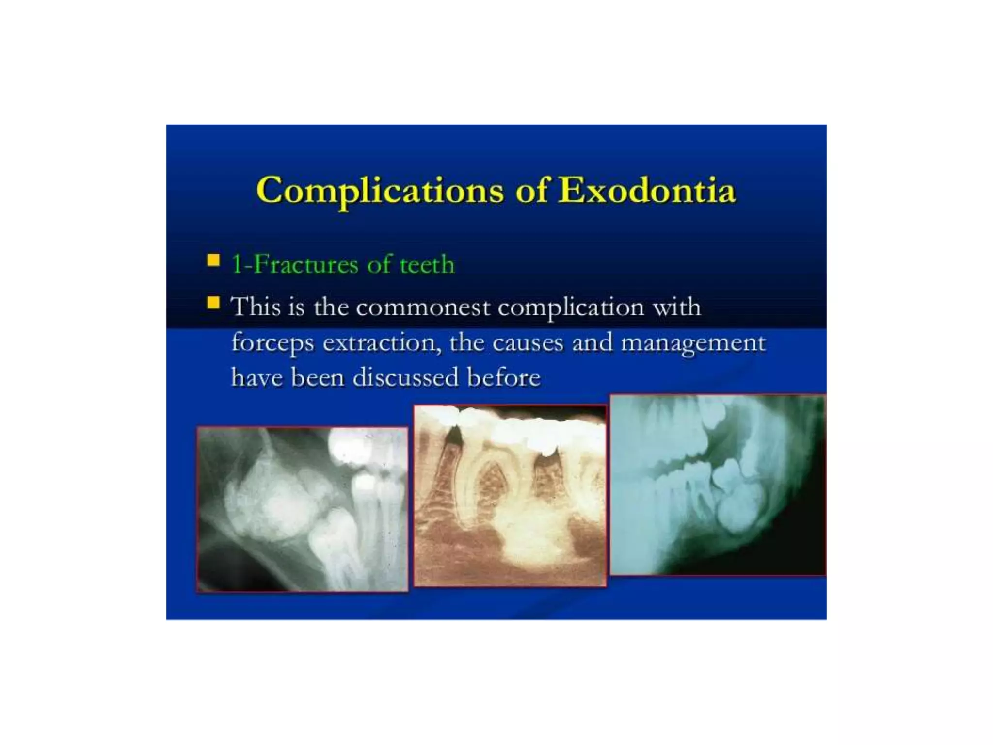 Complications of tooth Extraction.pptx | Dental Health | Diseases and ...