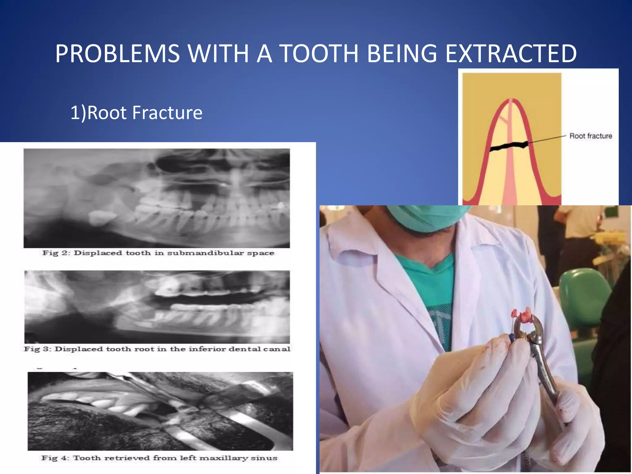 Complications of tooth extraction and its management (oral surgery) | PPTX