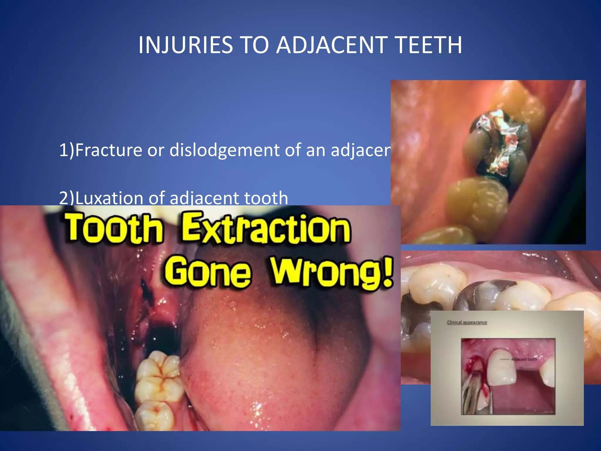 Complications of tooth extraction and its management (oral surgery) | PPTX