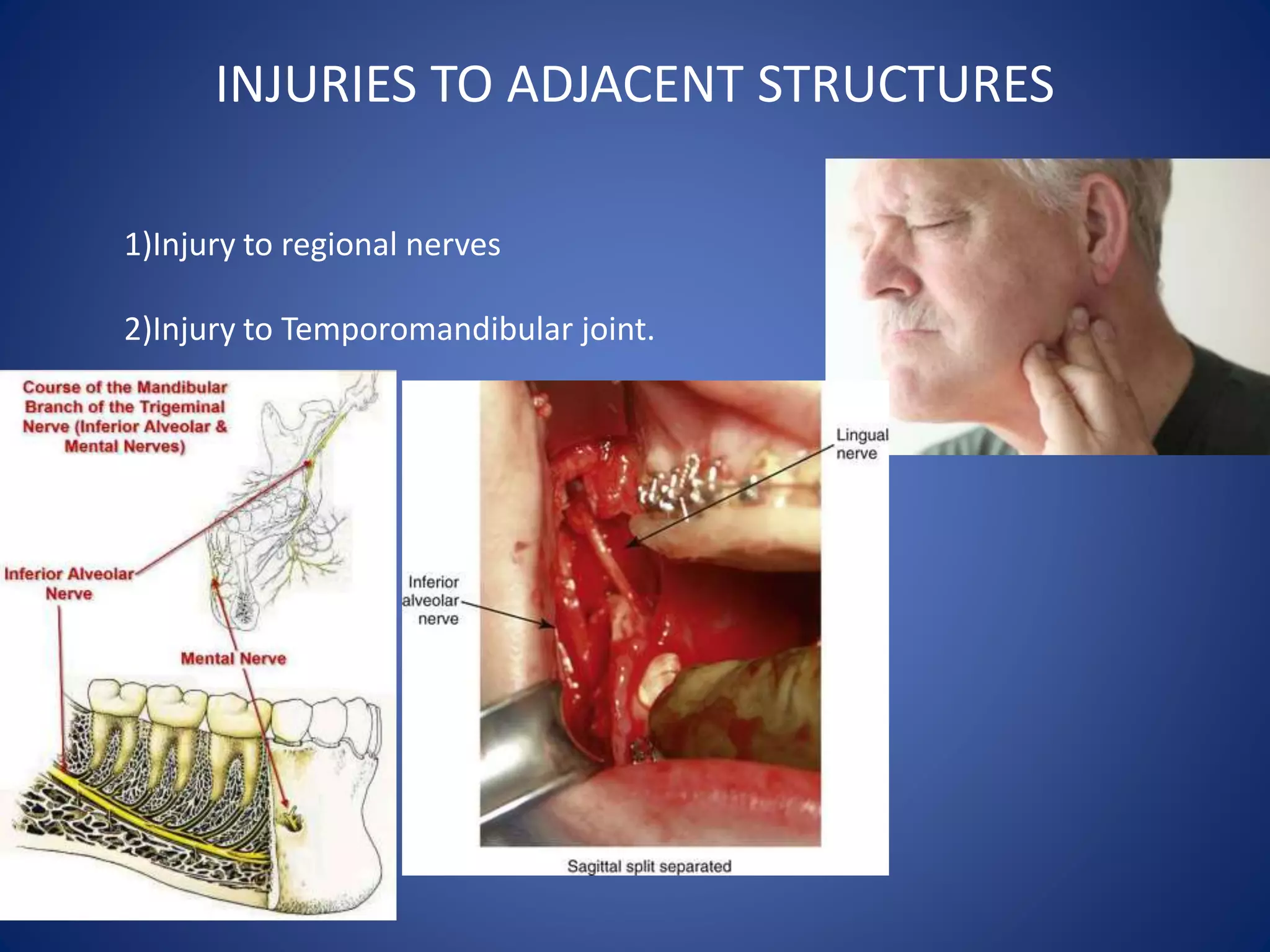 Complications of tooth extraction and its management (oral surgery) | PPTX