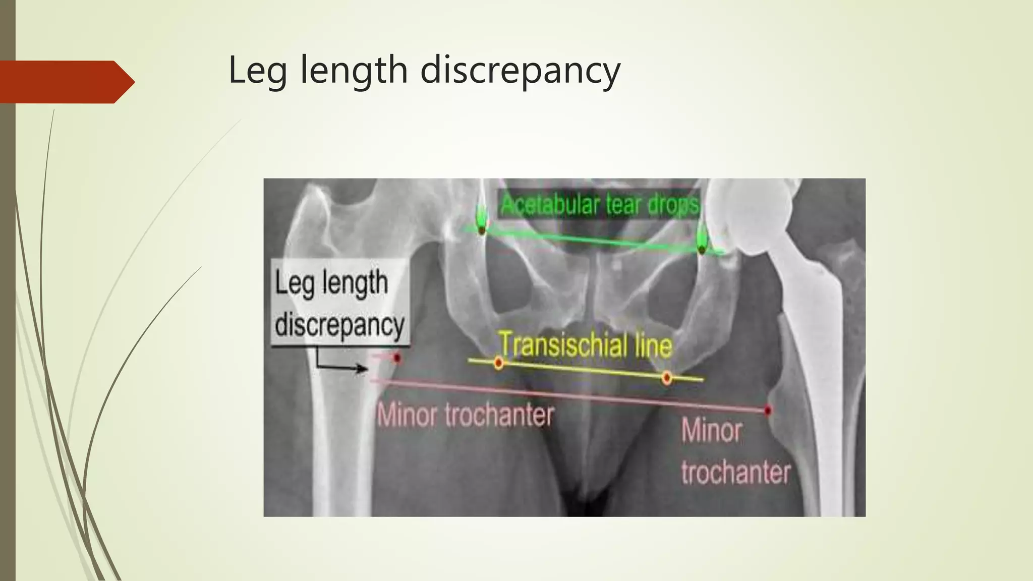 Complications of total hip replacement final | PPTX