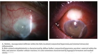 Complications of Trabeculectomy.pptx