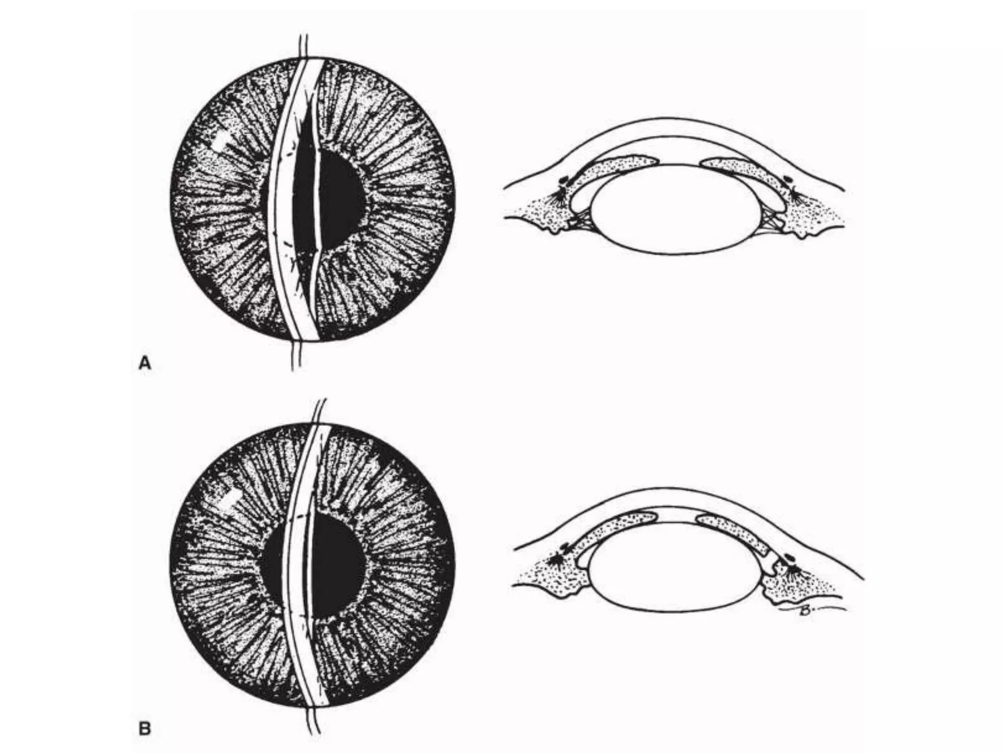 Complications of trabeculectomy | PPTX