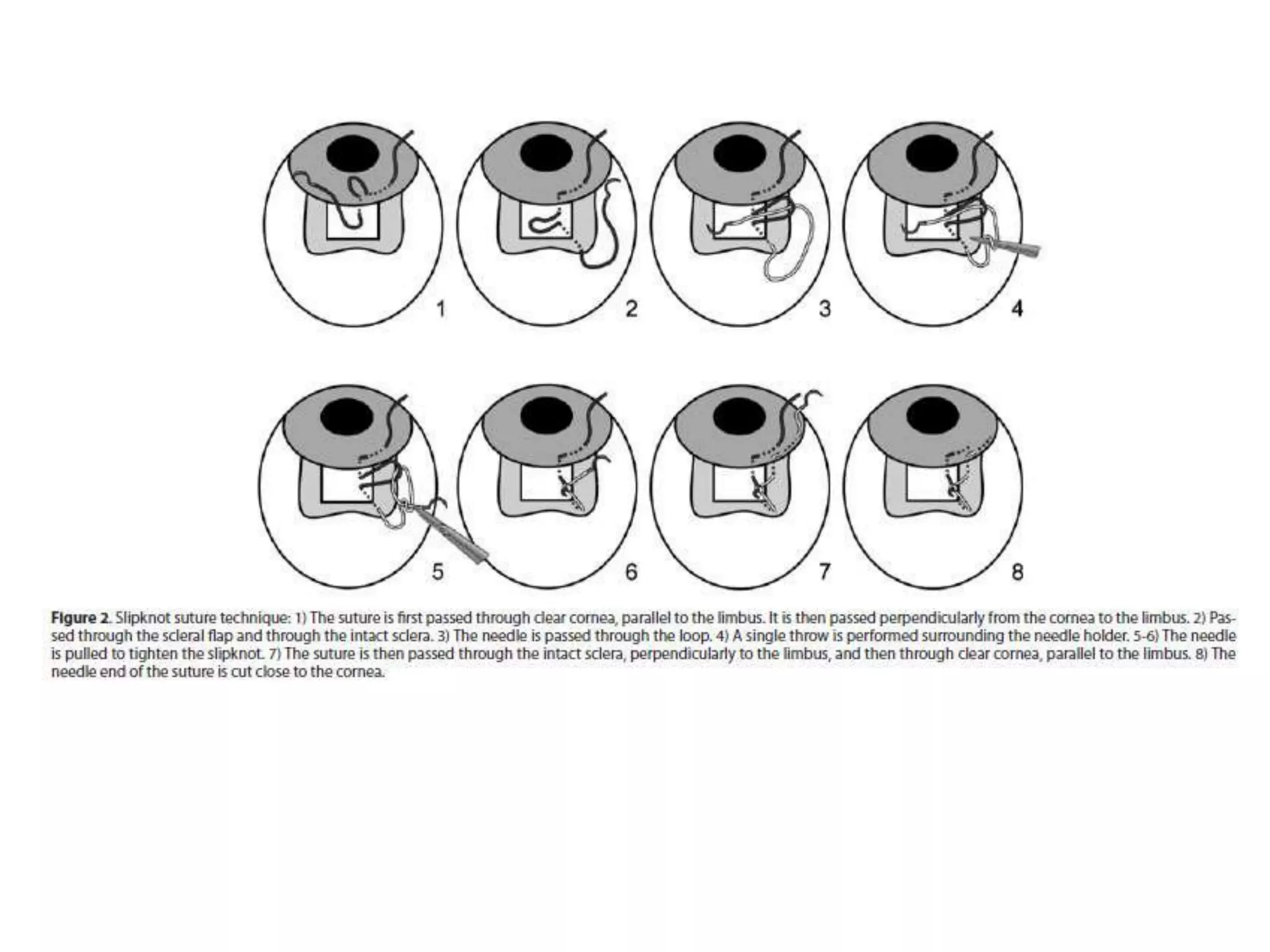 Complications of trabeculectomy | PPTX