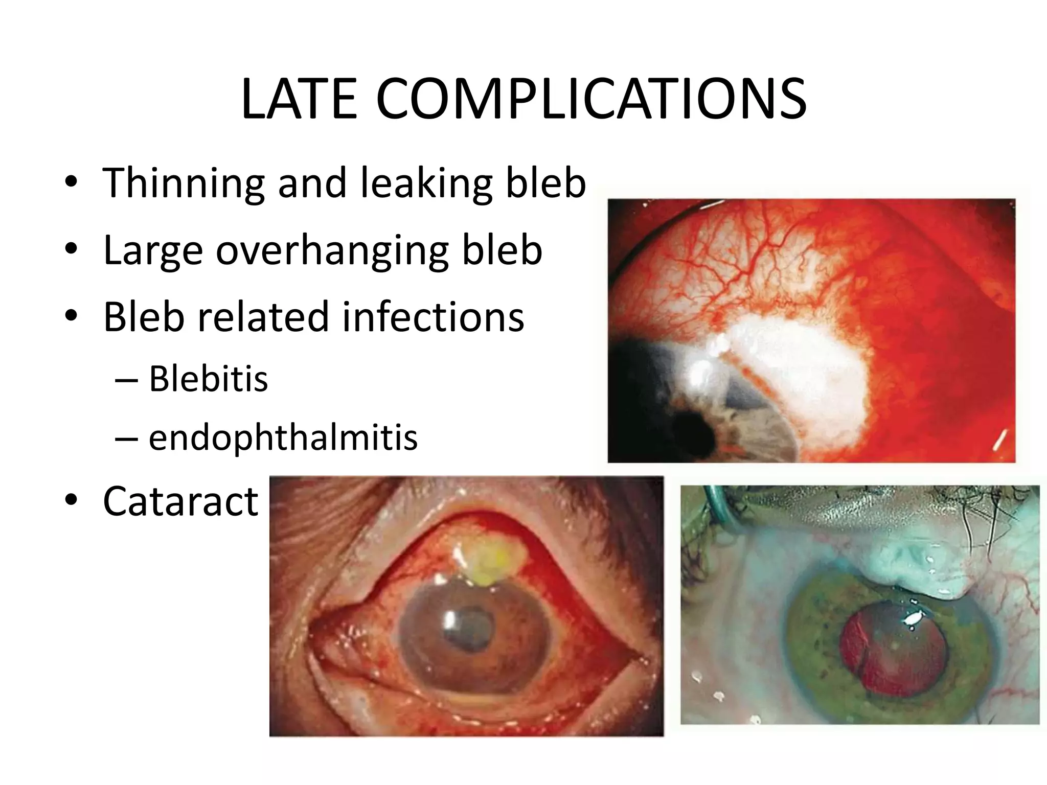 Complications of trabeculectomy | PPTX