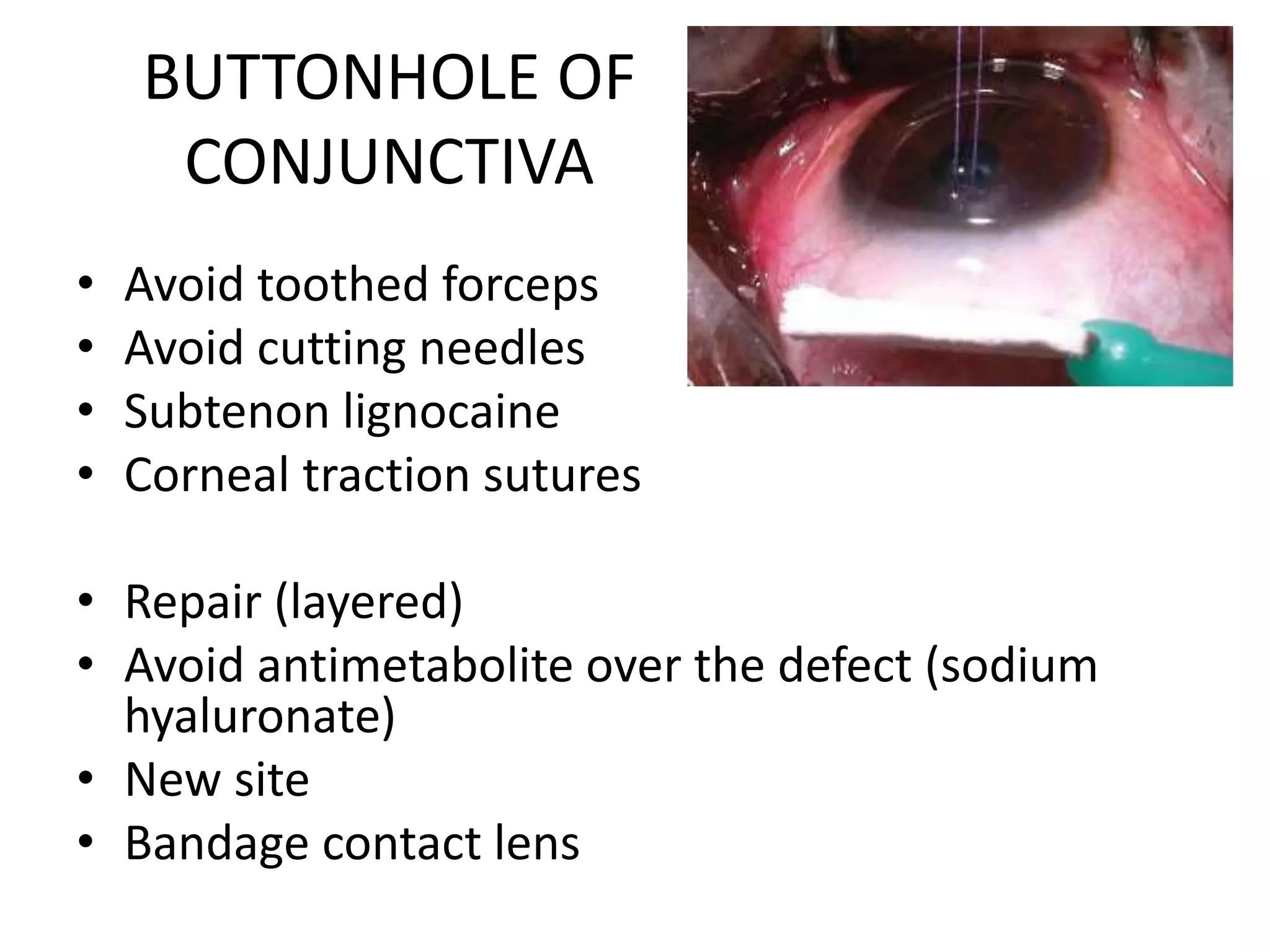 Complications of trabeculectomy | PPTX