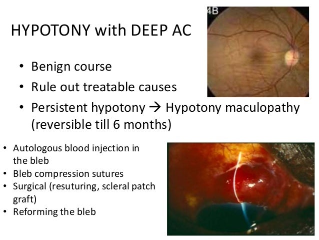 Complications of trabeculectomy