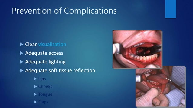 Complications of oral surgery