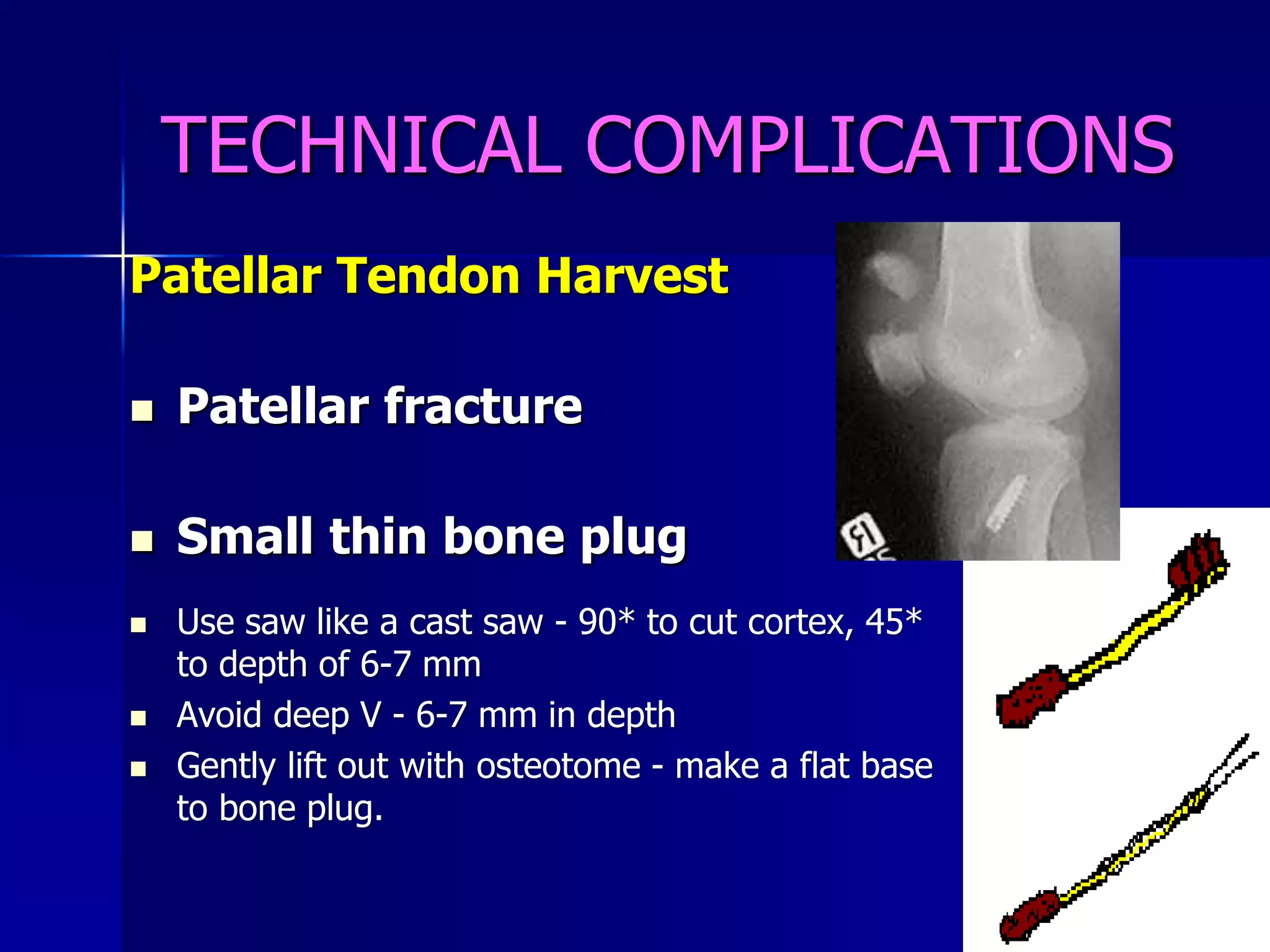 Complications in ACL reconstruction 2014 | PPTX