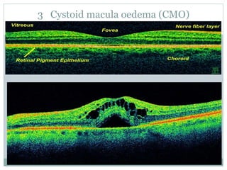 COMPLICATION OF CATARACT SURGERY | PPTX