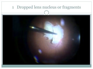 COMPLICATION OF CATARACT SURGERY | PPTX