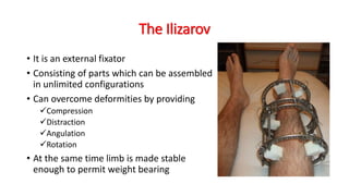 Compnents of the ilizarov ring fixator | PPTX