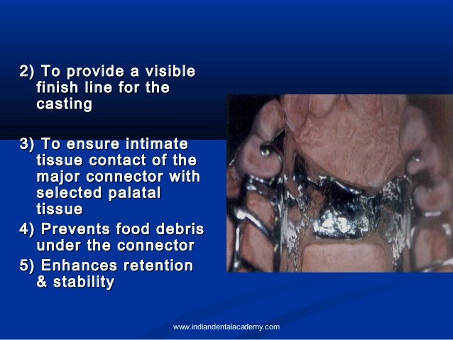 Component parts of cast partial dentures / orthodontic courses
