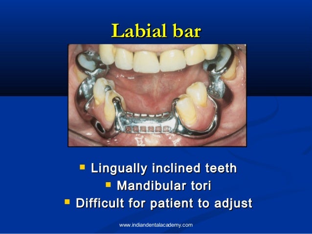 Role of component parts of cast partial dentures /dental courses