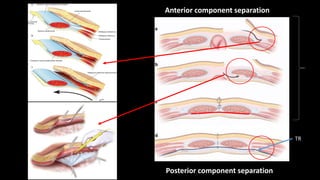 Component separation for ventral hernias prof. ahm shamsul alam | PPTX