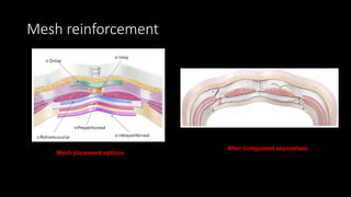 Component separation for ventral hernias prof. ahm shamsul alam | PPTX