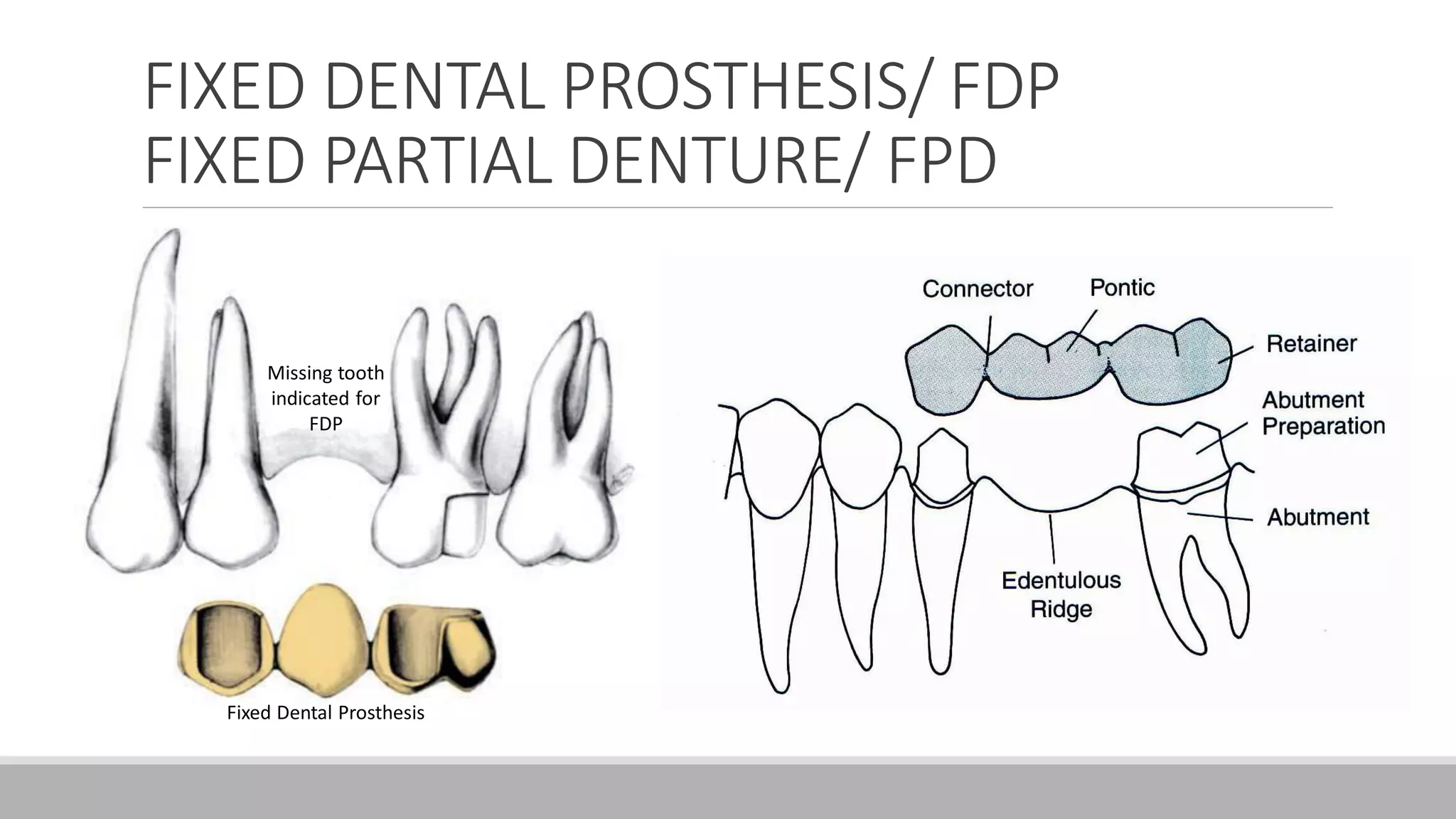 Components of Fixed Partial Denture | PDF