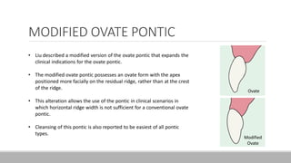 Components of Fixed Partial Denture | PDF