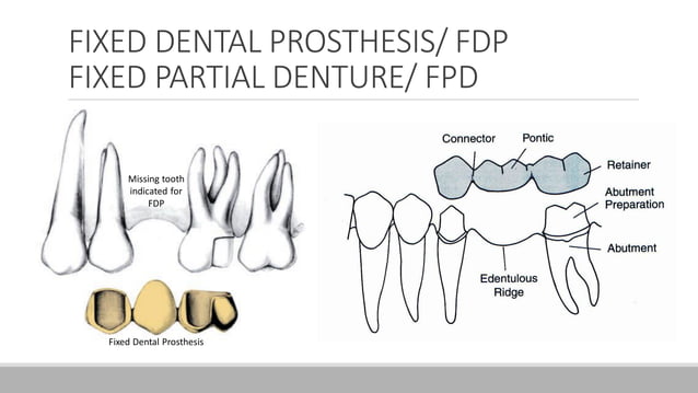 Components of Fixed Partial Denture