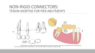 Parts Of Fixed Partial Denture